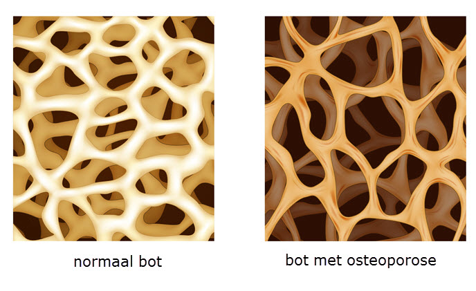 Osteoporose (botontkalking) - Slingeland Ziekenhuis