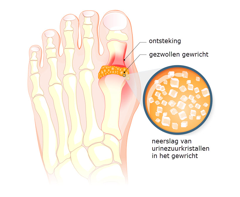 Kristalartritis - Slingeland Ziekenhuis